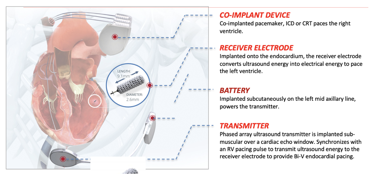Newsletter Juin 2023 – Etude SOLVE-CRT avec le stimulateur sans sonde ...
