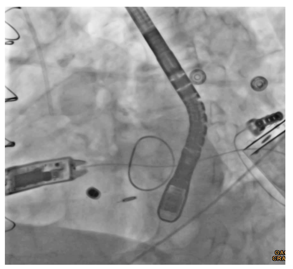 Newsletter Juin 2023 – Etude SOLVE-CRT avec le stimulateur sans sonde ...